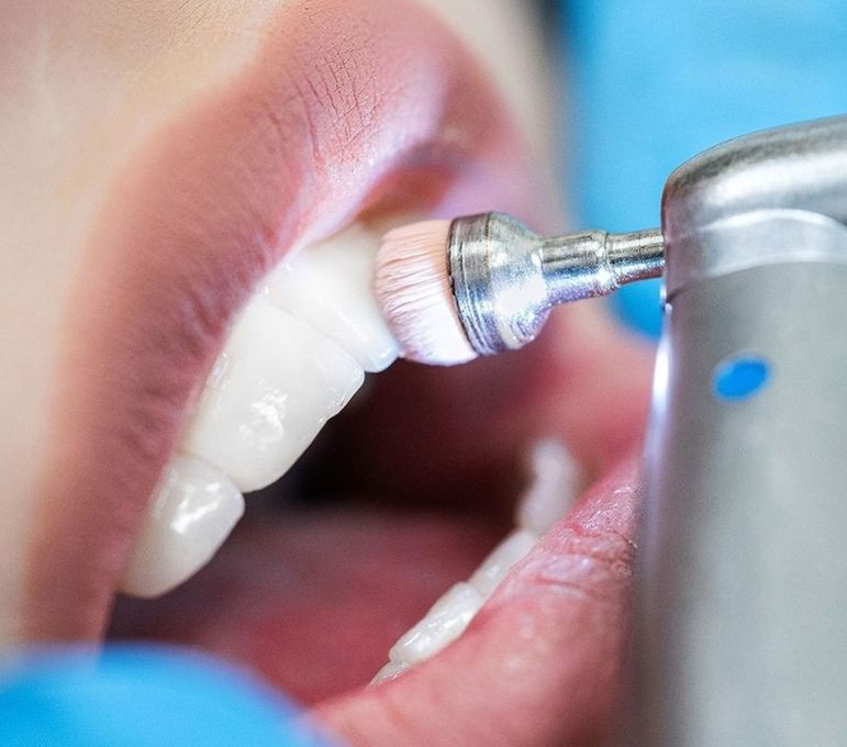 Professionelle Zahnreinigung in Eschborn | Zahnprophylaxe